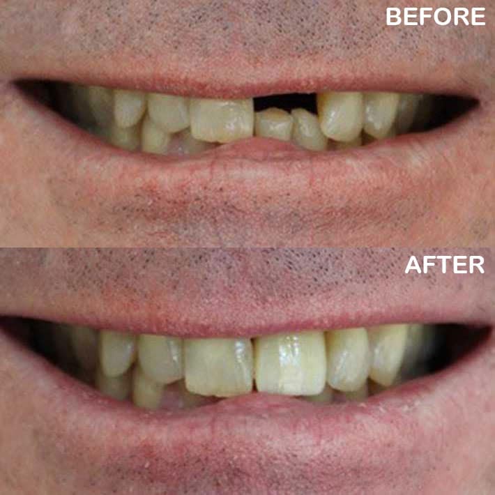 Bad Teeth Before And After