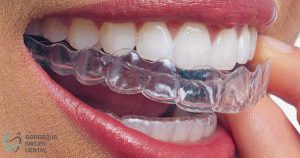 What Are Invisalign Attachments? Everything You Should Know