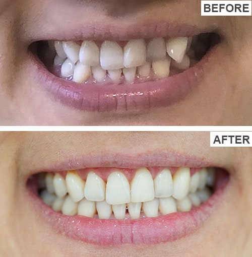 Invisalign Before And After Pictures - Goregous Smiles