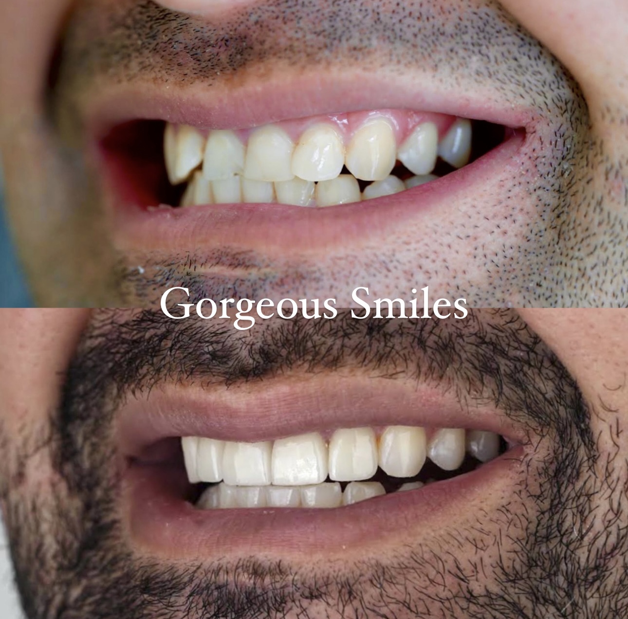 Invisalign Before And After Pictures - Goregous Smiles